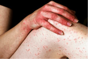 Allergex | WHAT ARE THE MOST COMMON ALLERGIES THAT ALLERGEX NON-DROWSY ...